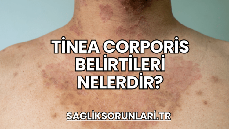 Tinea Corporis Belirtileri Nelerdir? - Sağlık Sorunları